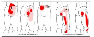 Sciatica Trigger Points Map: A Comprehensive Guide - MED CARE LINE