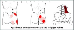 Sciatica Trigger Points Map: A Comprehensive Guide - MED CARE LINE